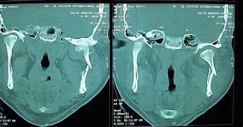 Subcondylar Fracture Of The Mandible Ct Scan