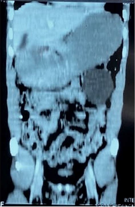 Adult With Concurrent Mesenteric Cyst And Acute Appendicitis A Case