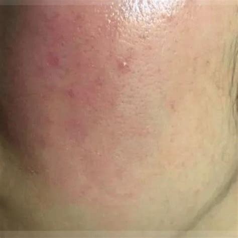 얼굴 홍조 원인 겨울 안면홍조크림 추천템 네이버 블로그