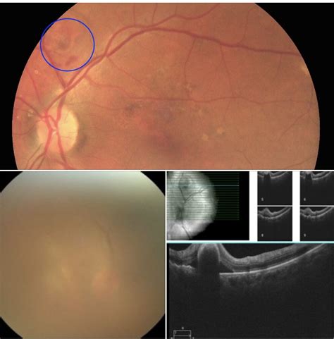 Ophthalmology Cases And Hypotheses Och Journal On Linkedin Uveitis