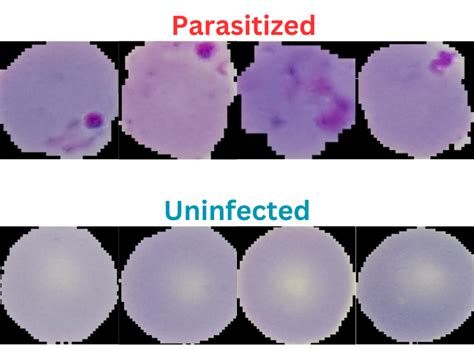 Malaria Classification With Vision Transformer And Pytorch