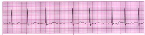 Ecg Interpretation Flashcards Quizlet