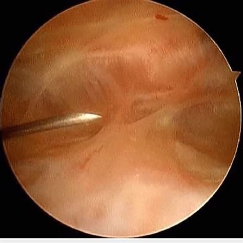 Arthroscopic View Of The Suprapatellar Region Of The Right Knee