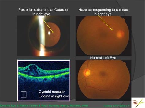 Drushti Eye And Retina Center Role Of Oct In Evaluation Prior To Cataract Surgery