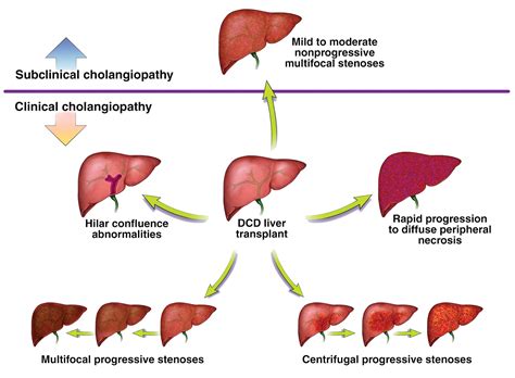 Radiologic Characterization Of Ischemic Cholangiopathy In Donation After Cardiac Death Liver