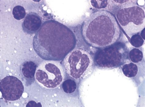 Dysgranulopoiesis Hypogranular Neutrophils Bone Marrow Download Scientific Diagram