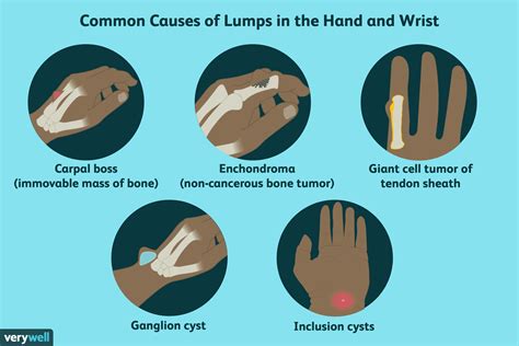 Lump On Top Of Wrist