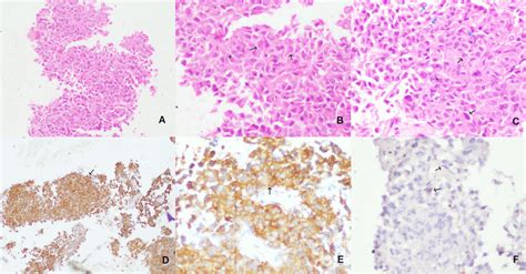 Photomicrographs Showing A Gist Predominantly Composed Of Pleomorphic