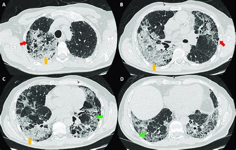 Computed Tomogram Of The Chest In Lung Windows Shows Honeycombing Red Download Scientific