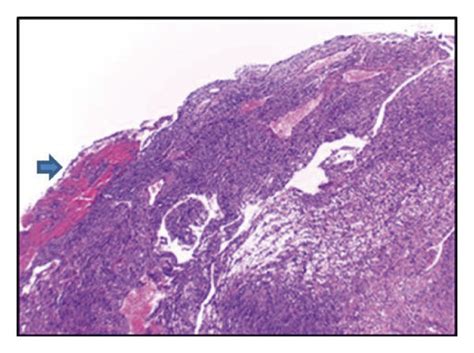 Histopathology Results With 4x Magnification The Green Arrows Show