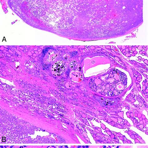 An Example Of Noninvasive Follicular Thyroid Neoplasm With
