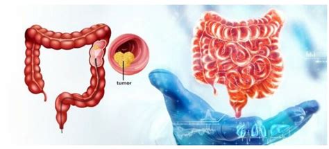 ИНТЕРВЈУ СО ДОЦ Д Р АНДРЕЈ НИКОЛОВСКИ Појава на крв во столицата запек течни столици болки