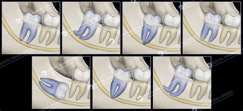 Classification Of The Third Molar In Relation To Inferior Alveolar