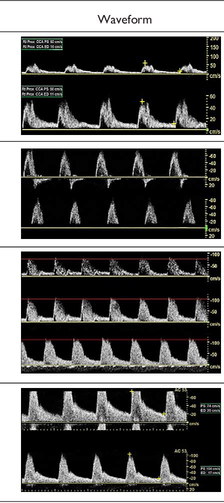 Table 18 From Interpretation Of Peripheral Arterial And Venous Doppler Waveforms A Consensus