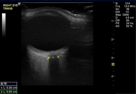 Optic Nerve Sheath Diameter