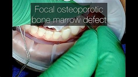 Focal Osteoporotic Bone Marrow Defect Of The Jaws At Aron Desrochers Blog