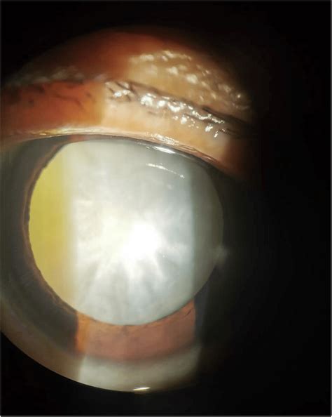 Representative Slit Lamp Image Of The Lens With Cortical Opacity Of