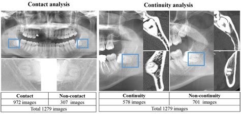 Classification Of The Relationship Between The Mandibular Third Molar Download Scientific