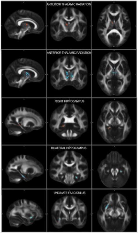 Tract Based Spatial Statistics Reveals Increased White Matter