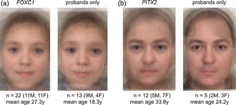 Gene‐specific Facial Dysmorphism In Axenfeld‐rieger Syndrome Caused By