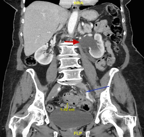 Acg Case Reports Journal