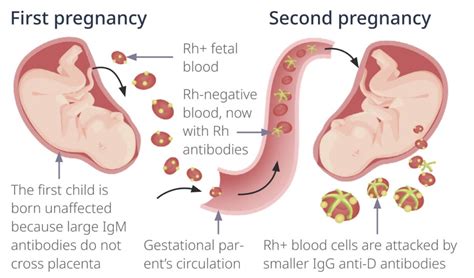 Rh Incompatibility [ Free Cheat Sheet] Lecturio Nursing