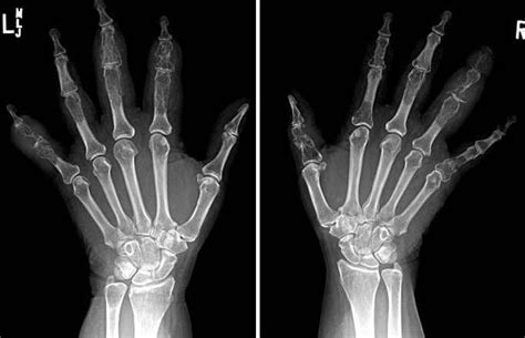 Recognizing And Managing The Musculoskeletal Manifestations Of Sarcoidosis