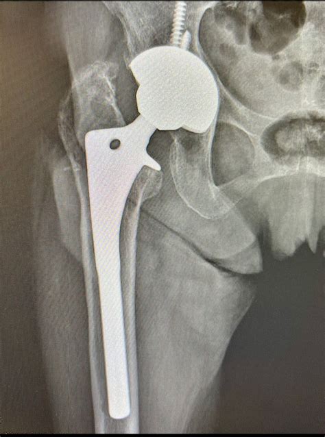 Watson Extraction System On Linkedin Orthopedics Orthopedicsurgeon Orthopedicsurgery