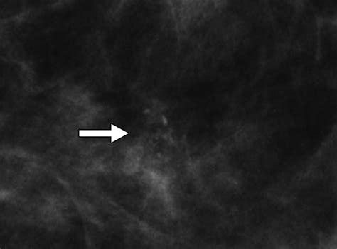 Breast Calcifications The Focal Group Ajr