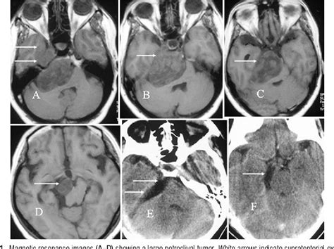 Figure 1 From Obsessive Compulsive Disorder And Cingulotomy Semantic