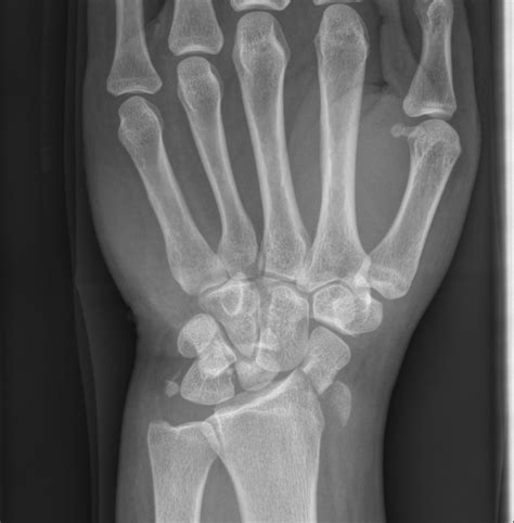 Radiopaedia Case Trans Scaphoid Perilunate Fracture Dislocation Id