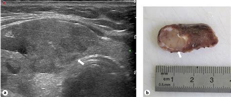 Insight Into Differentiated Thyroid Cancer Gross Pathological Specimen
