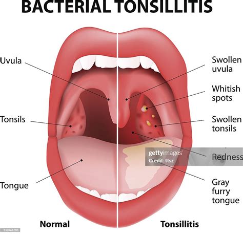 Bacterial Tonsil Infection