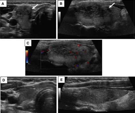 A Grayscale Ultrasound Transverse Right Upper Thyroid And B