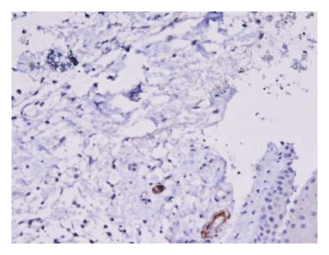 Histopathology A C A Polypoidal Lesion Lined By Hyperplastic Download Scientific Diagram