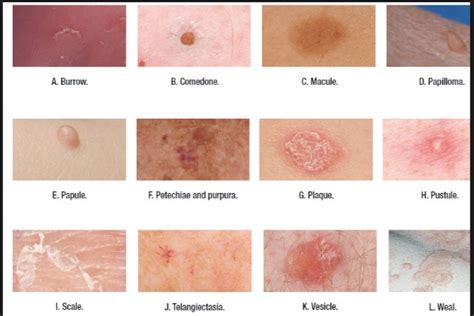 Skin Lesion Types For Nursing Students Dermatology Nurse Skin
