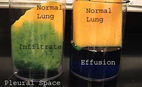 Pulmonary Infiltrates Effusions Flashcards Quizlet
