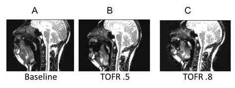How To Pick The Best Quantitative Neuromuscular Monitoring Device For Your Anesthesia Department