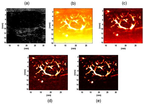 non local based denoising framework for in vivo contrast free
