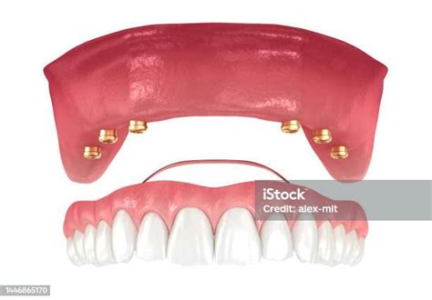 6 개의 임플란트를 기반으로 한 탈착식 보철물 치과 3d 그림 이빨에 대한 스톡 사진 및 기타 이미지 이빨 일러스트레이션 건강관리와 의술 Istock