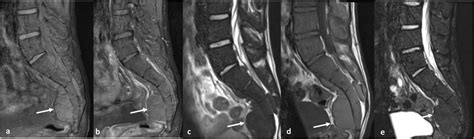 Sagittal Mri Of The Sacrum Showing A Well Defined Presacral Mass White