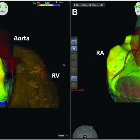 Activation Map Of Sinus Rhythm Merged With Cardiac Computed Tomography Download Scientific