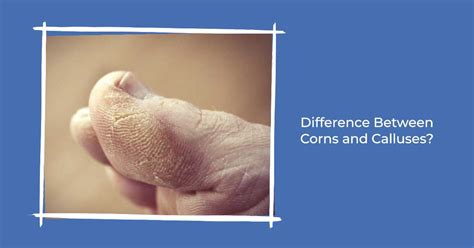 What Is The Difference Between A Corn And A Callus