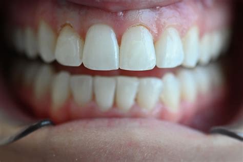 Enameloplasty Dentist In Frisco Tx