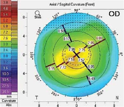 Pentacam Oculus Systems Wetzlar Germany Corneal Topography Map Of A