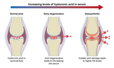 Flashcard Synovial Fluid Analysis Quizlet