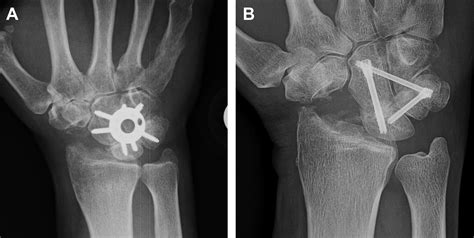 Postoperative Imaging Of The Wrist And Hand Magnetic Resonance
