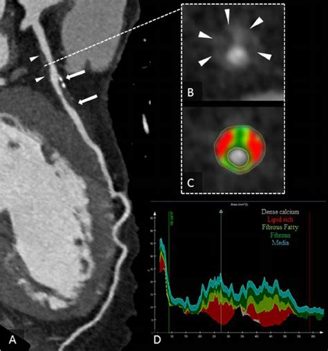 Representation Of Plaque Quantification Using Dedicated Semiautomated