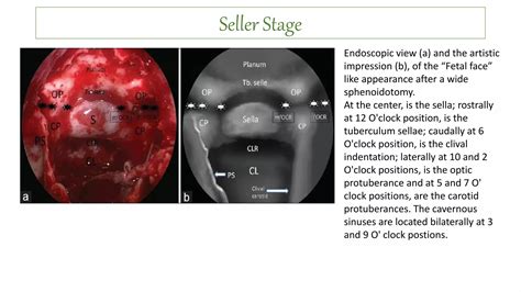 An Overview Of Endoscopic Endonasal Trans Sphenoidal Approachpptx