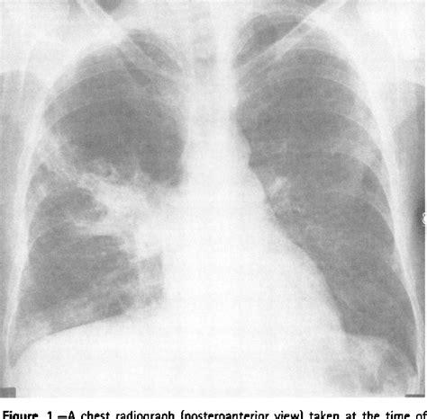 Figure 1 From Indolent Staphylococcus Aureus Pneumonia Semantic Scholar